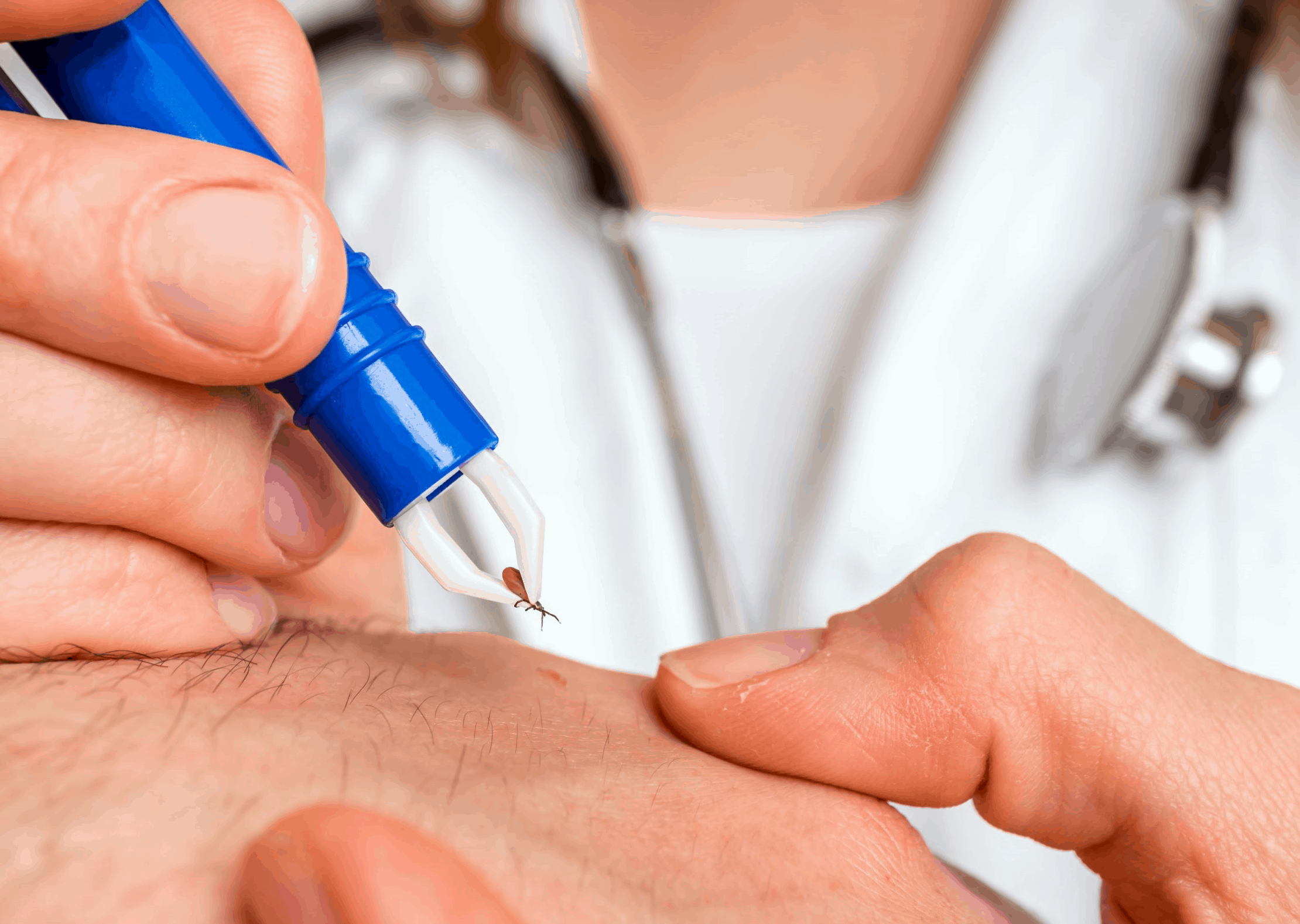 What Is Lyme Disease? Symptoms, Treatment, and How To Prevent It ...